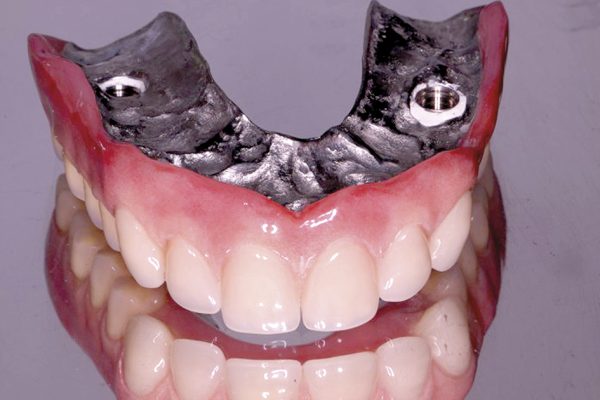 IMPLANT-RETAINED MAXILLARY OVERDENTURE FOR FAILING UPPER BRIDGES Case ...